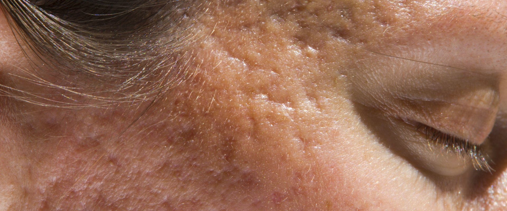 Can Botox Injections Cause Skin Problems?