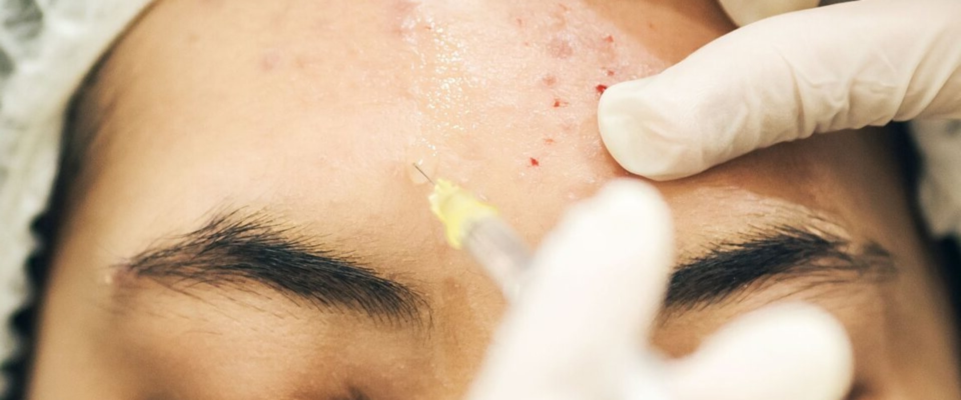 Should I Get Botox for Acne Treatment?